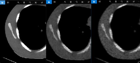 Denosing Lung Ct Scans Using Neural Networks With Interactive Code — Part 4 Convolutional
