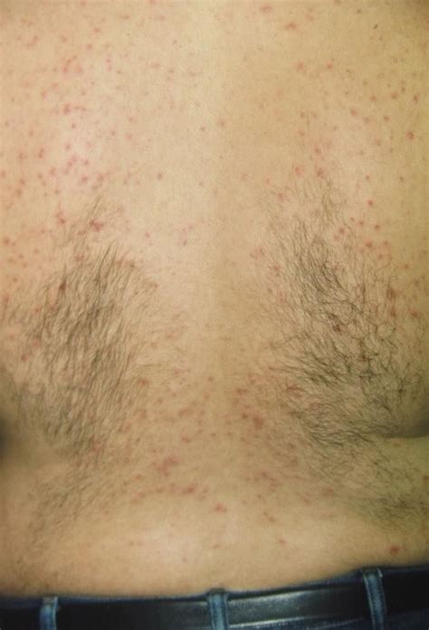 Imagemiliaria Rubra Prickly Heat Msd Manual Professional Edition