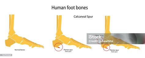 Human Foot Bones Plantar And Dorsal Spur Vector Illustration Stock