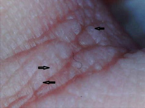 Aquagenic Syringeal Acrokeratoderma Localized To Palmar Creases Cosmoderma