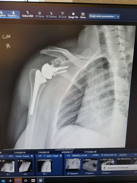 Reverse Shoulder Replacement Surgery Rradiology