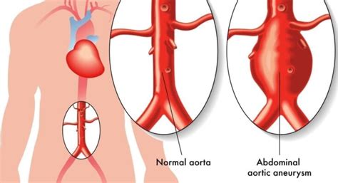 Abdominal Aortic Aneurysm Diagnosis And Treatment