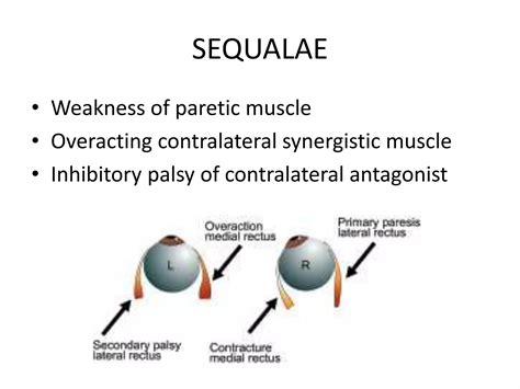 Paralytic Squint Pptx