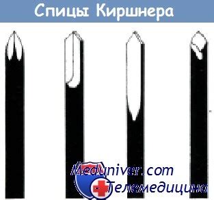Внутри- и чрезкостная иммобилизация металлическими спицами (внутреннее ...