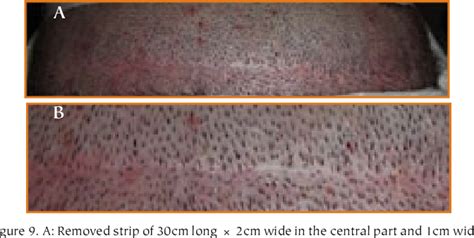 Figure 1 From Getting Maximum Follicular Units To Do A Megasession