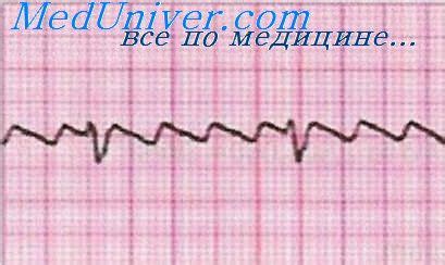Тахиаритмия torsades de pointes. Ухудшение гемодинамики при терапии аритмий