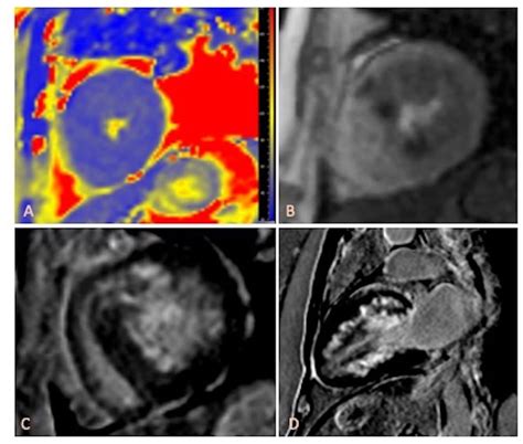 Syncope In An Elderly Man With Hypertrophic Obstructive Cardiomyopathy