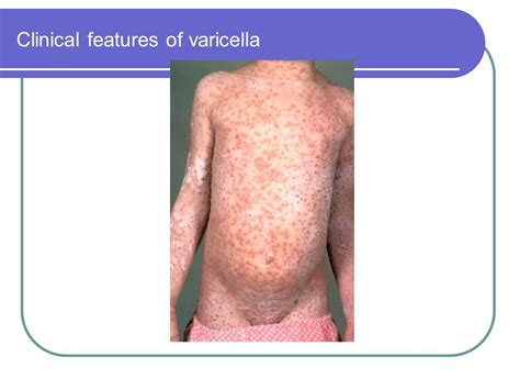 Viral Pathogenesis An Overview Sciencedirect Topics 45 Off