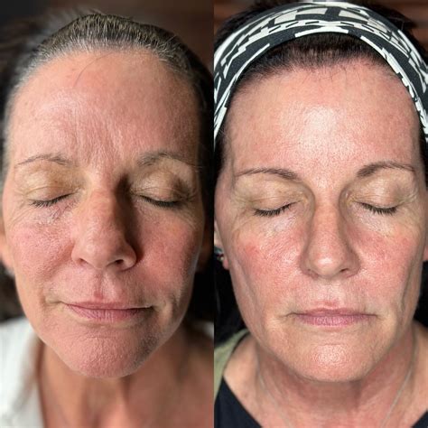 Morpheus8 Contouring And Resurfacing Age Management By Hce