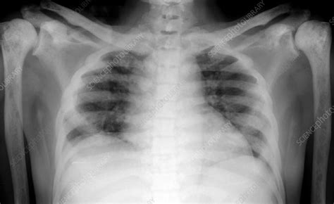 Chest Wall Bone Metastasis X Ray Stock Image F Science Photo Library
