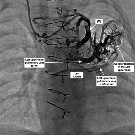Selective Contrast Injection In The Vv Demonstrated Intraparenchymal