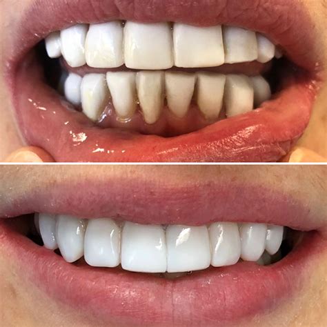 Bioclear Before And After Boulton Dental