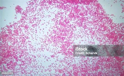 Microscopic View Of Cerebrospinal Fluid From A Patient With