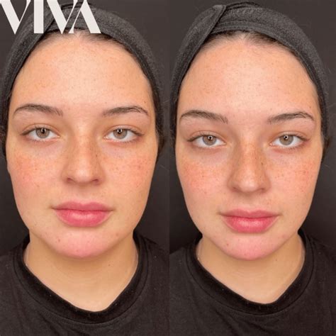 What Is Facial Contouring Viva Skin Clinics Blog