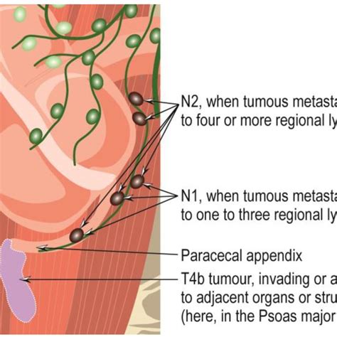 Definition Of Primary Tumor T1t4a In Appendix Adenocarcinomas