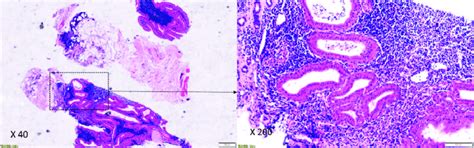 He Staining Of Parotid Gland Adenolymphoma Magnification Â200 He