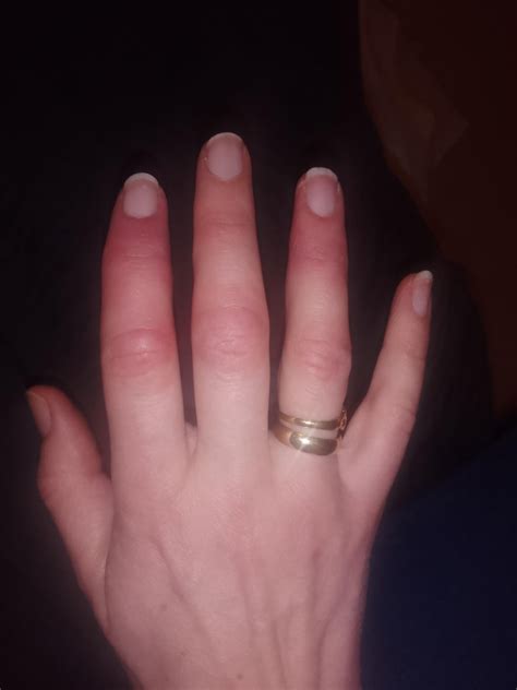 Could This Be Chilblains R Raynauds