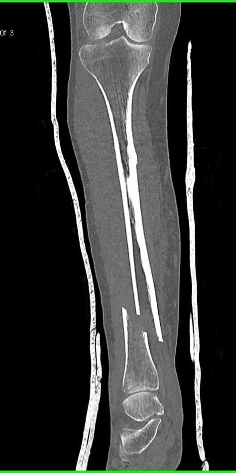 Spiral Fractures Of The Tibia And Fibula Musculoskeletal Radiology