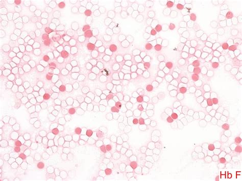 Kleihauer Betke Test Fetal Hemoglobin Stain Stock Illustration Illustration Of Betke Fetal