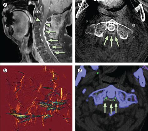 Cervical Spinal Gout The Lancet Rheumatology