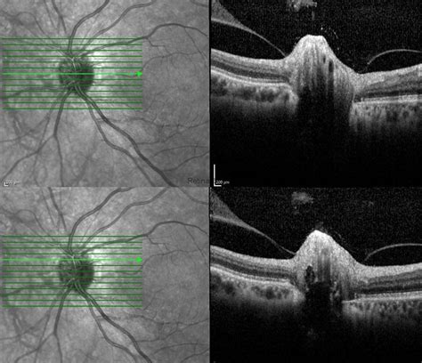 Optic Nerve Head Drusen Retinara