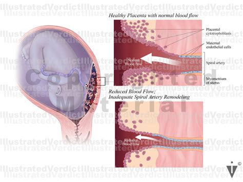 Stock Pregnancy Delivery Placental And Umbilical Anomalies