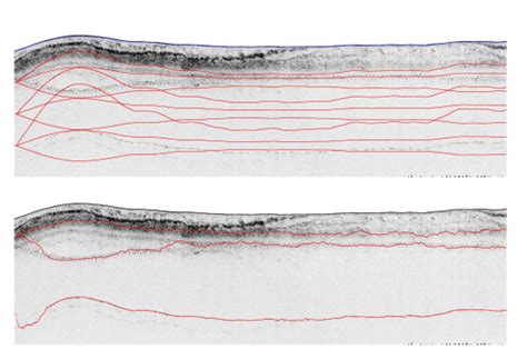 Multiple Suppression Filter Chesapeake Technology
