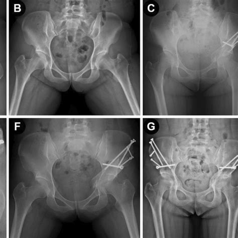 Preoperative Radiograph And Post Operative Correction Of A 22 Years Old
