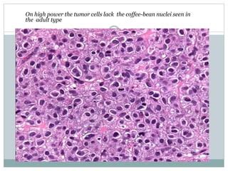 Sex Cord Stromal Tumors PATHOLOGY PPTX