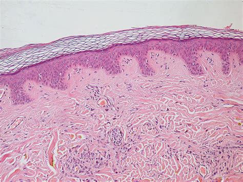 Dermis Wikipedia