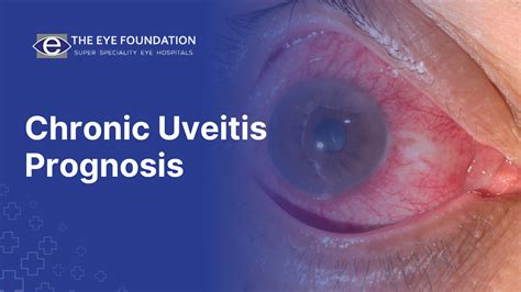 What Is The Prognosis For Someone With Chronic Uveitis