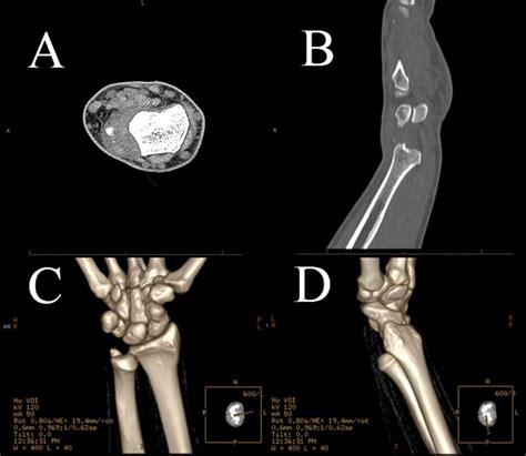 Isolated Volar Radioulnar Joint Dislocation With Associated Ulnar
