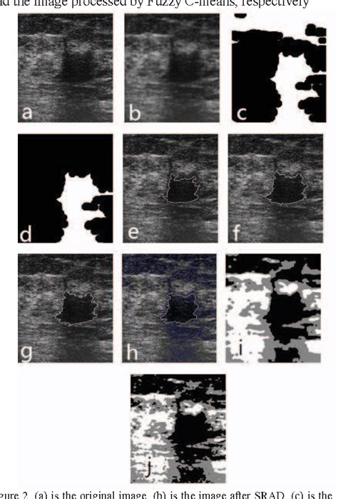Figure 2 From Automatic Segmentation Algorithm Of Breast Ultrasound