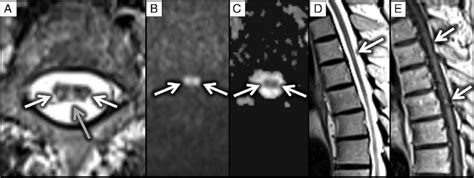 Axial T2 A And Diffusion Weighted B Images Demonstrate T2