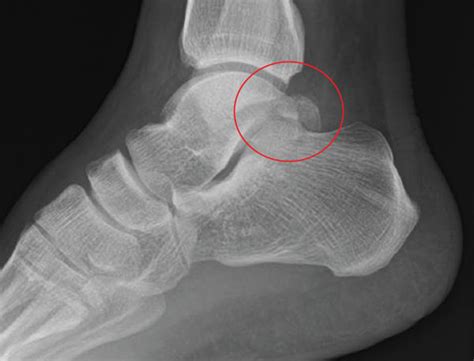 Talus Lateral Process Fracture