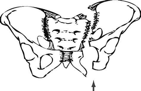 Fractures Of The Pelvis Bone Joint