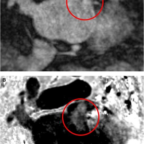 Left Atrial Appendage Thrombus Indicated With A Red Arrow On Tee Heart Download Scientific