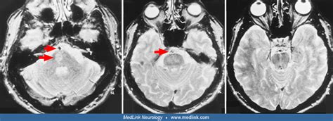 Basilar Artery Stroke Medlink Neurology