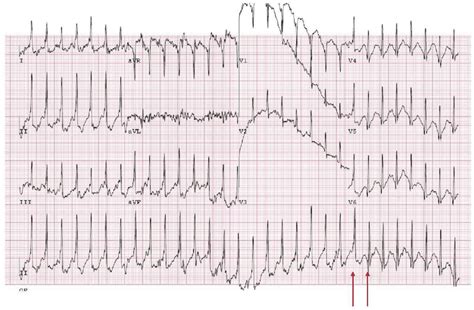 Abrupt Loss Of Preexcitation During Exercise Stress Testing The Ecg Download Scientific