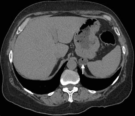 A 65 Year Old Female With Rheumatoid Arthritis Chest Ct Showing A