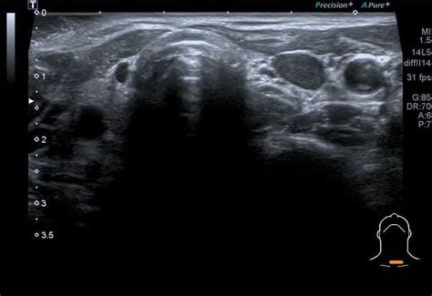 Parathyroid Gland Ultrasound