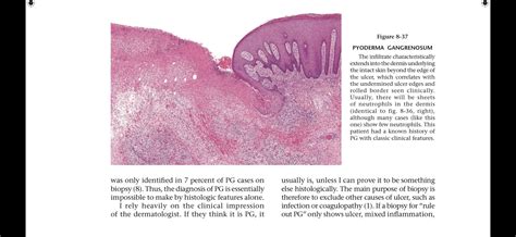 Jerad Gardner Md On Twitter How I Handle Nonspecific Ulcers On