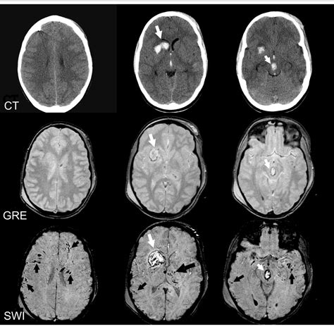 Diffuse Axonal Injury Mri