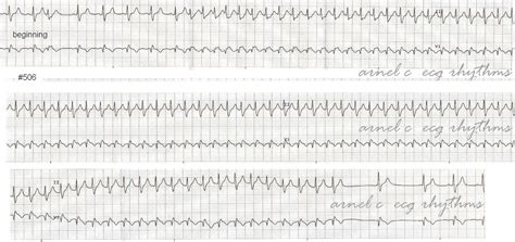 Ecg Rhythms Which Svt The Need To Capture The Beginning Of An Svt
