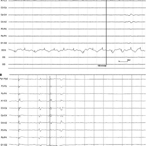 Burst Suppression This Eeg Is Showing Burst Suppression Activity In