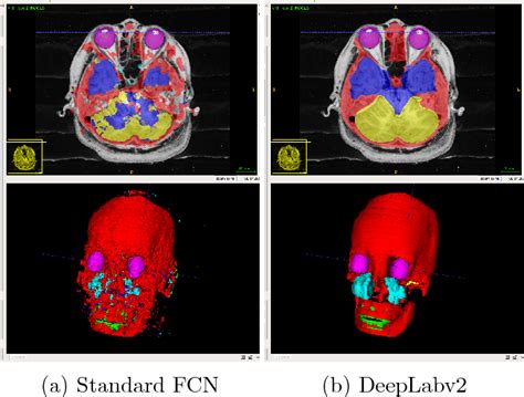 Comparison Of The Deep Learning Based Automated Segmentation Methods