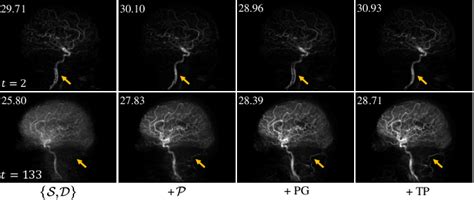 figure 11 from 3d vessel reconstruction from sparse view dynamic dsa