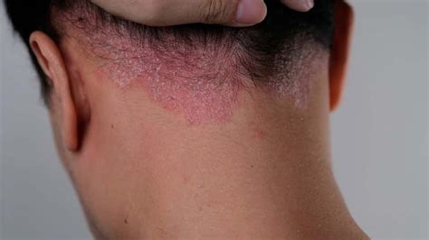 Psoriasis And The Environment Causes And Triggers