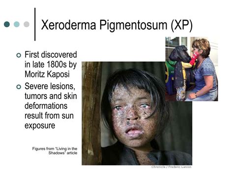 Ppt Xeroderma Pigmentosum Xpf And Nucleotide Excision Repair