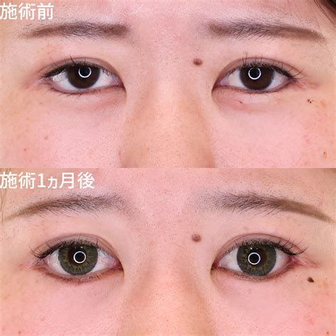 タレ目形成逆さまつ毛改善 グラマラスなお目元で印象 ｜症例写真・ビフォーアフター｜美容整形･美容外科のtaクリニックグループ